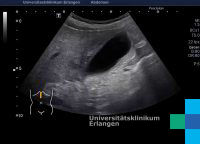 Gallbladder stones – Atlas of Ultrasound