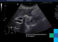 Akute Cholezystitis – Sonographieatlas Erlangen