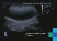Gallbladder polyps – Atlas of Ultrasound