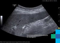 Gallbladder polyps – Atlas of Ultrasound