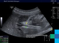 Biliary stents – Atlas of Ultrasound