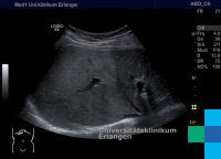 Focal fatty infiltration – Atlas of Ultrasound