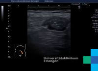 Diverticulitis – Atlas of Ultrasound