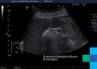 Accessory spleen – Atlas of Ultrasound