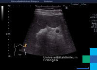 Accessory spleen – Atlas of Ultrasound