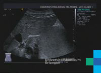 Splenomegaly – Atlas of Ultrasound