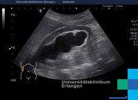 Harnstau – Sonographieatlas Erlangen