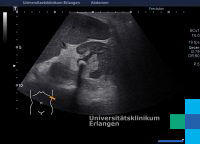 Nephrolithiasis – Atlas of Ultrasound