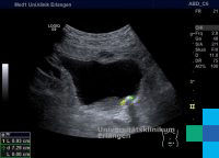Blasenstein – Sonographieatlas Erlangen