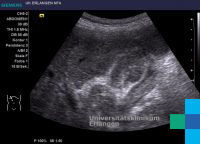Akute Cholezystitis – Sonographieatlas Erlangen