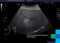 Angiomyolipom – Sonographieatlas Erlangen