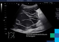 Peritonitis – Atlas of Ultrasound