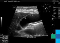 Gallbladder polyps – Atlas of Ultrasound