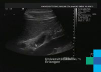 Gallbladder polyps – Atlas of Ultrasound