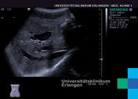 Caroli disease – Atlas of Ultrasound
