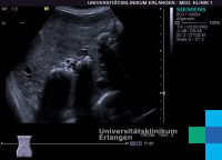 Caroli disease – Atlas of Ultrasound