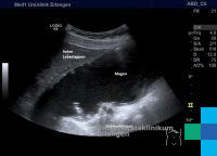 Normal Stomach – Atlas of Ultrasound