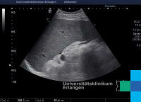 Splenomegaly – Atlas of Ultrasound