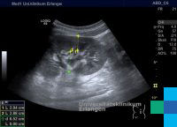 Pyelonephritis – Atlas of Ultrasound