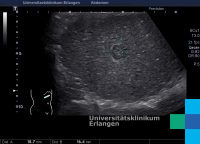 Small HCC (series of images/videos) – Atlas of Ultrasound