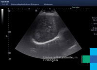 Diffuse growing HCC infiltrating the portal vein (series of images ...