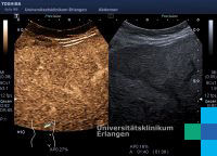Focal fatty sparing (series of images) – Atlas of Ultrasound