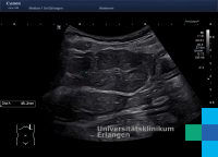 Focal nodular hyperplasia – Atlas of Ultrasound
