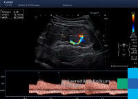 Focal nodular hyperplasia – Atlas of Ultrasound