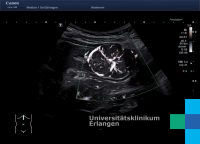 Focal nodular hyperplasia – Atlas of Ultrasound