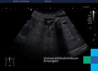 Lymph nodes – Atlas of Ultrasound