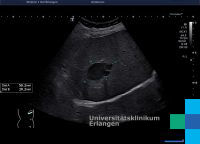 Complex liver cyst (series of images) – Atlas of Ultrasound