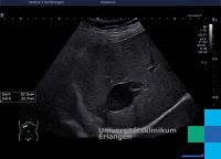 Complex liver cyst (series of images) – Atlas of Ultrasound