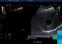 Complex liver cyst (series of images) – Atlas of Ultrasound
