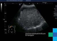 Ascites – Atlas of Ultrasound