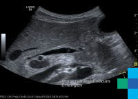 Akute Pankreatitis – Sonographieatlas Erlangen