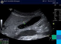 Akute Pankreatitis – Sonographieatlas Erlangen