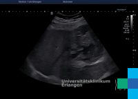 Gallbladder perforation – Atlas of Ultrasound
