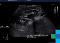 Nephrolithiasis – Atlas of Ultrasound
