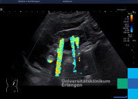 Nephrolithiasis – Atlas of Ultrasound