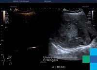 HCC with infiltration into inferior vena cava (IVC) (series of images ...