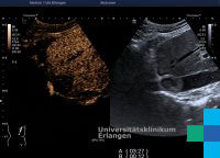 HCC with infiltration into inferior vena cava (IVC) (series of images ...