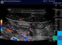 Appendicitis – Atlas of Ultrasound