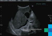 Free fluid – Atlas of Ultrasound
