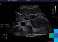 Pancreatic tail carcinoma – Atlas of Ultrasound