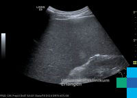 Splenomegaly – Atlas of Ultrasound