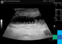 Ileus of small intestine – Atlas of Ultrasound