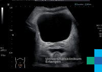 Douglas pouch – Atlas of Ultrasound