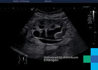 Harnstau – Sonographieatlas Erlangen