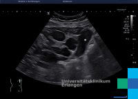 Normal Gallbladder – Atlas of Ultrasound