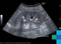 Harnstau – Sonographieatlas Erlangen